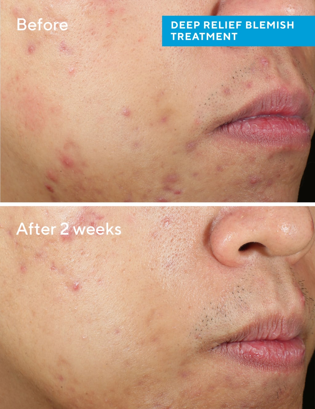 Deep Relief Blemish Treatment 30ml | Murad® | M&S